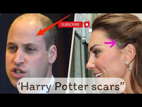 Kate Middleton and Prince William share a similar ‘Harry Potter scar ...
