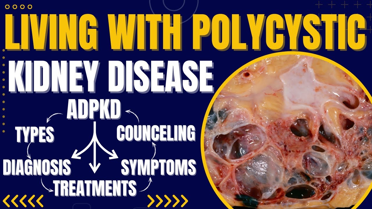 Understanding Autosomal Dominant Polycystic Kidney Disease (PKD ...