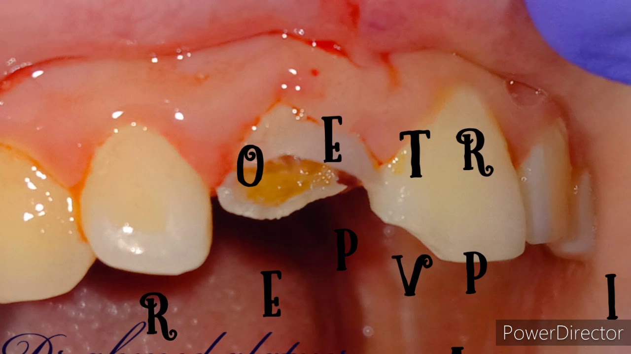 Endodontic treatment and post & core placement - YouTube