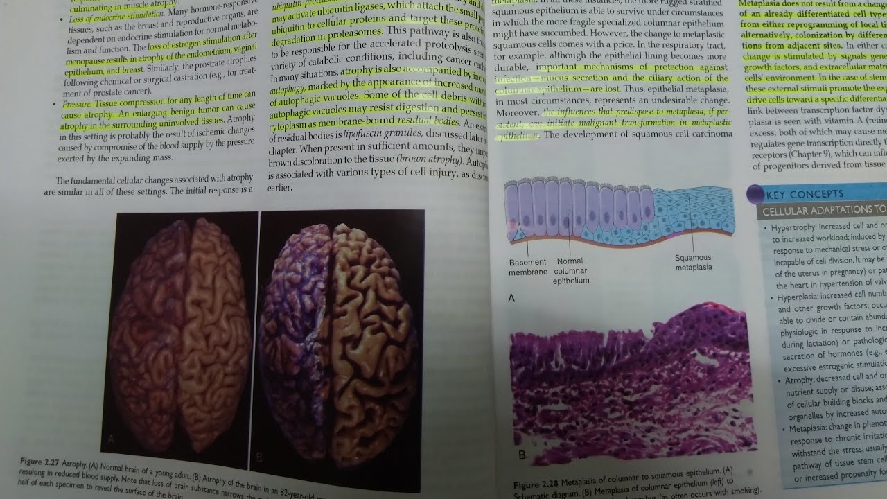 Cellular Adaptations - GENERAL PATHOLOGY - YouTube