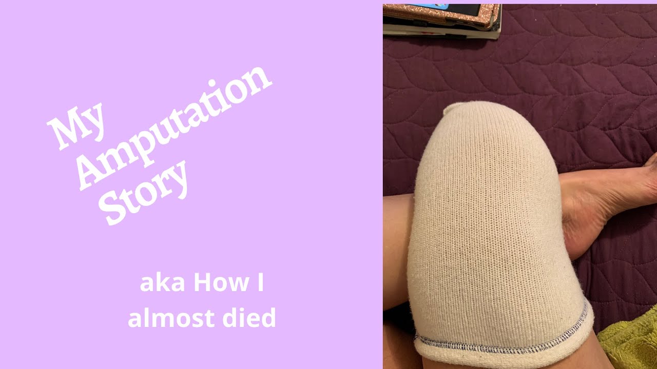 My AMPUTATION STORY or How I almost died. - YouTube