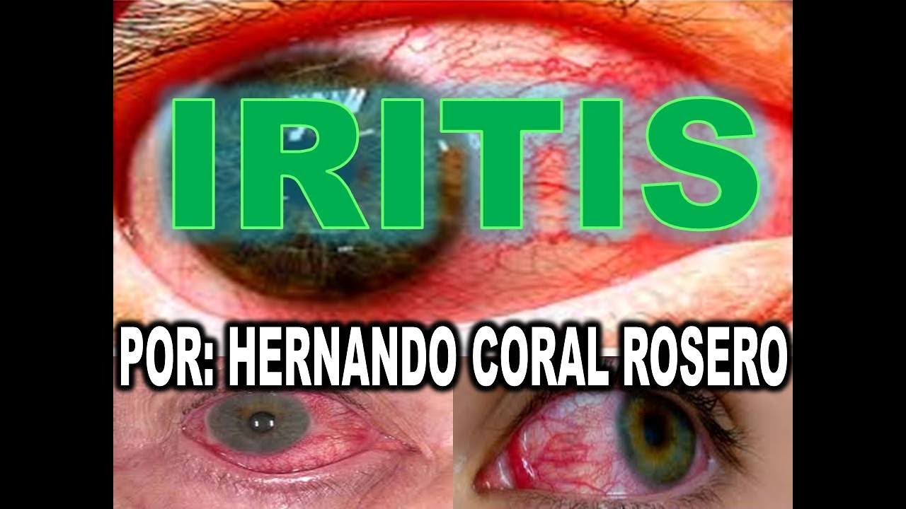 IRITIS Inflamación de los filamentos del iris ocular. - YouTube