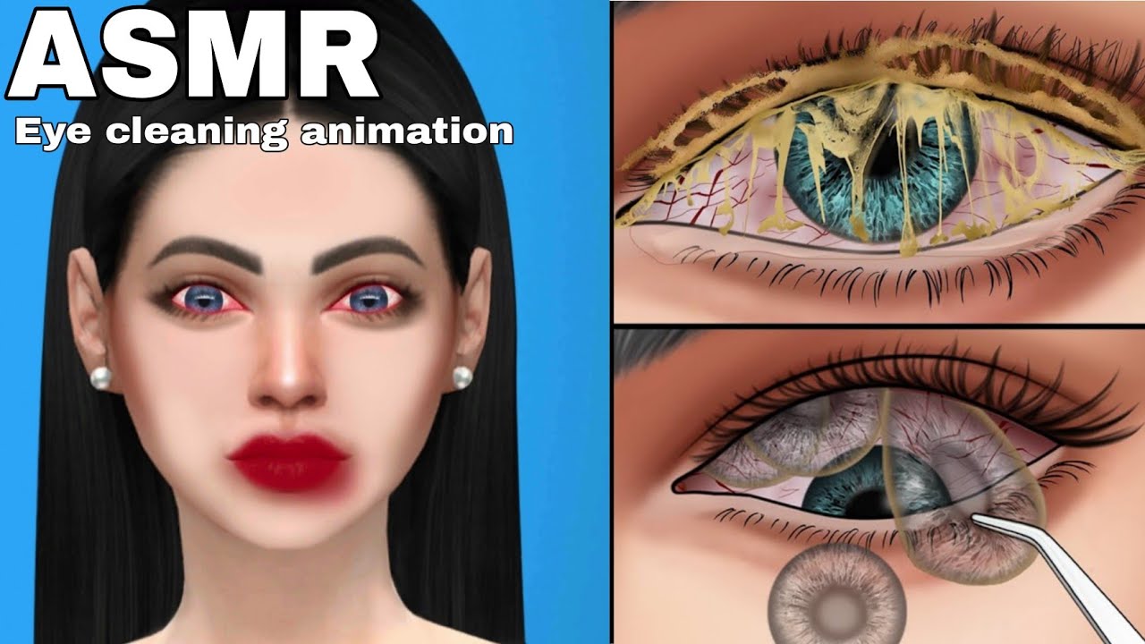 Unbelievable Eye Rheum Removal: The Must-See ASMR Guide! # ...