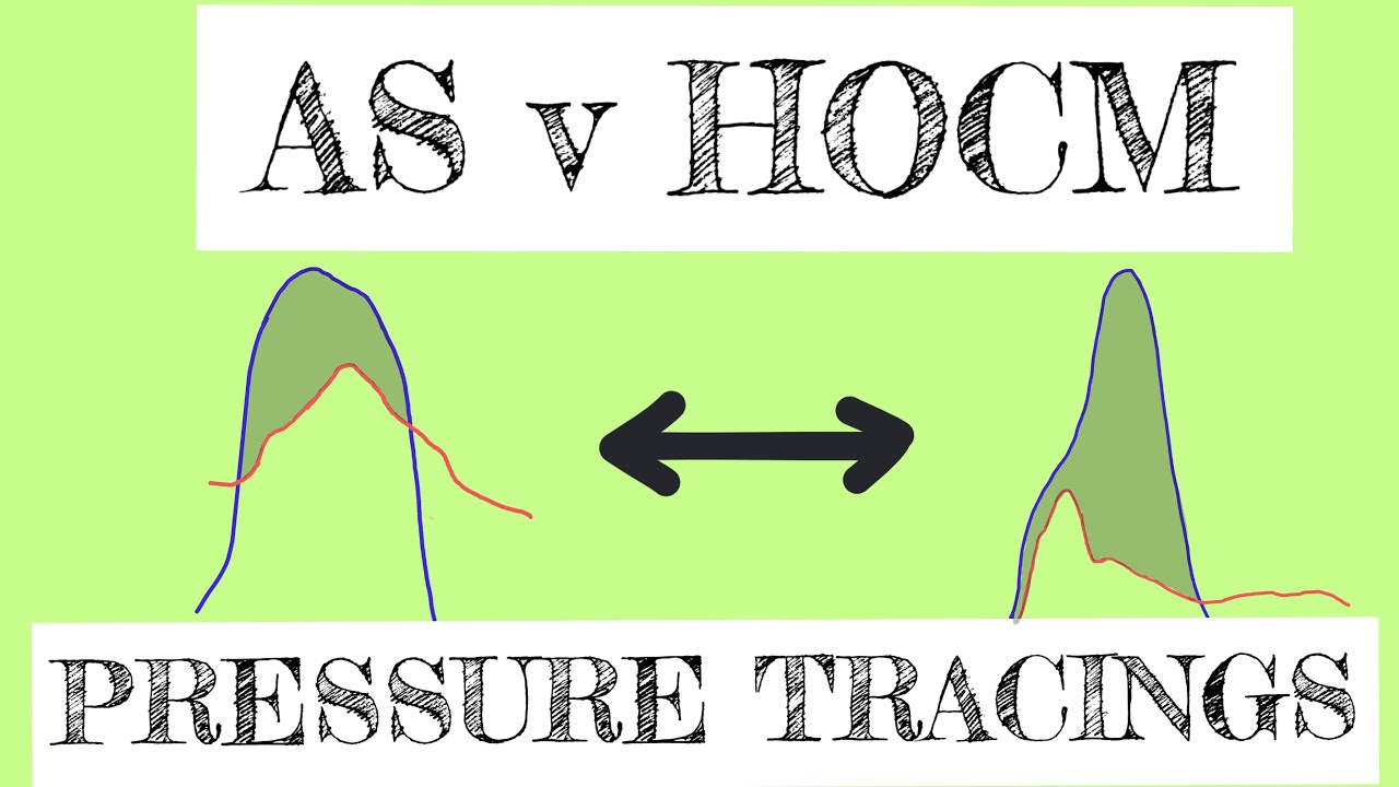 Aortic stenosis versus HOCM: pressure tracings - YouTube