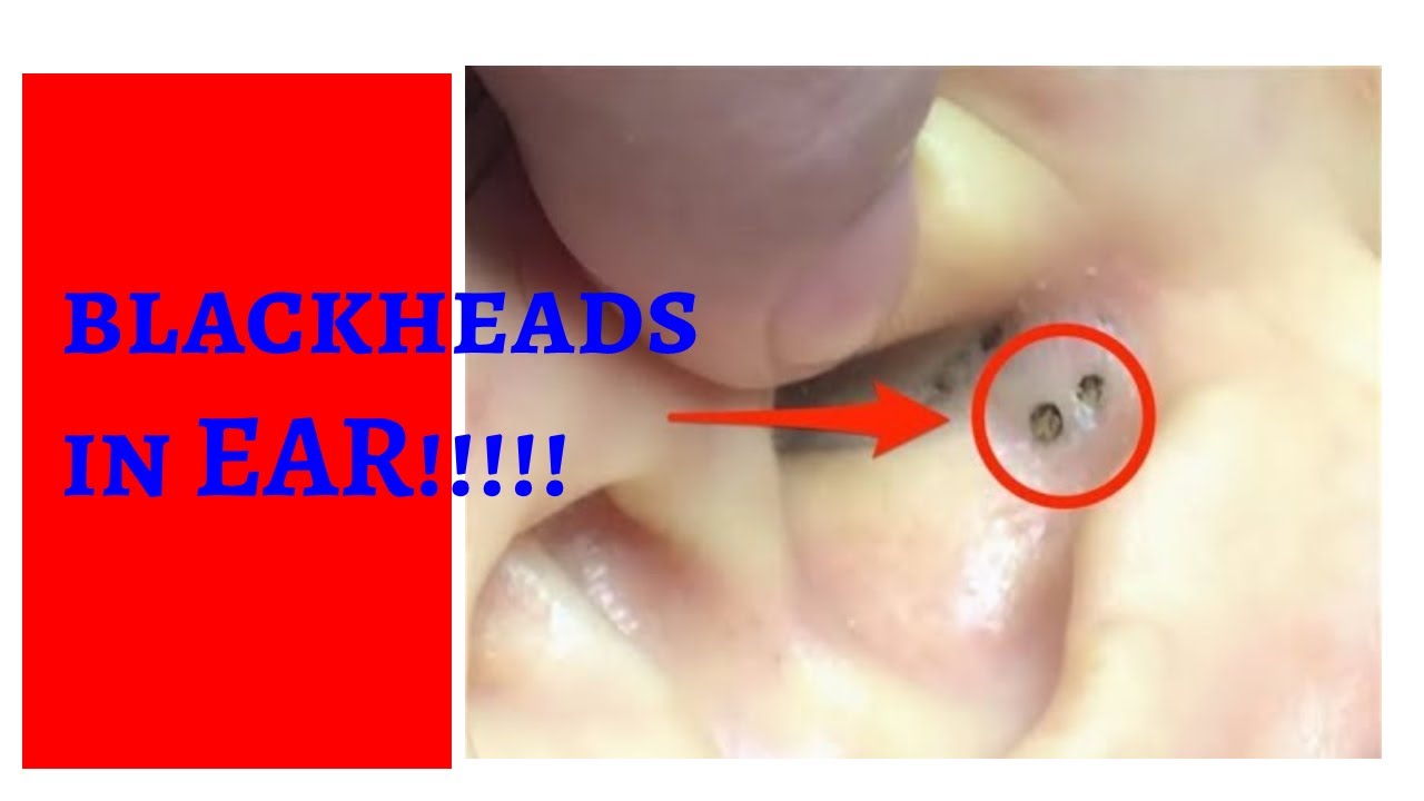 Best Blackhead Removal in EAR - Facial Acne Treatment -Mejor ...