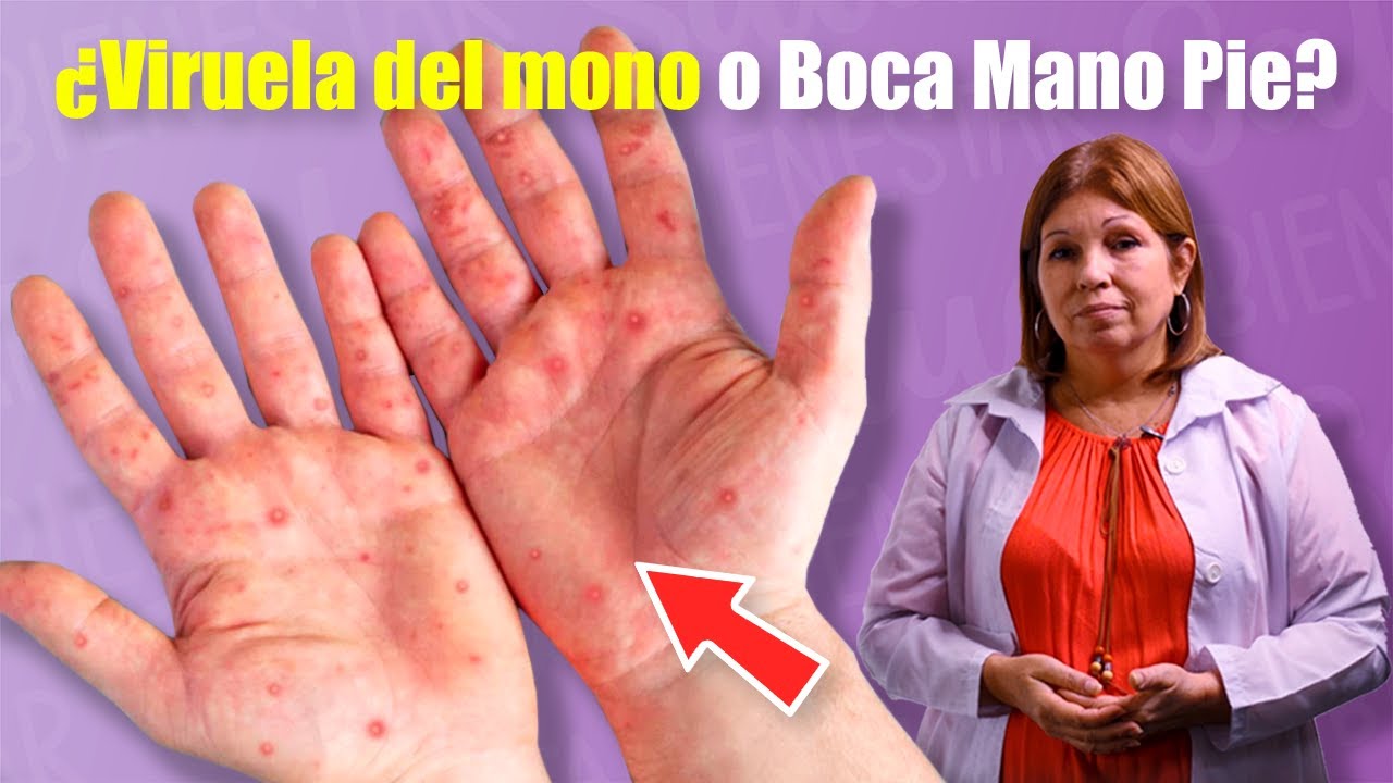 🔸LA ENFERMEDAD *BOCA MANO PIE* Y LA VIRUELA DEL MONO 🐵 ¿CÓMO ...