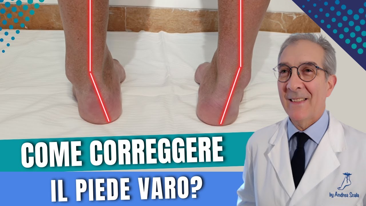 PIEDE VARO, CAUSE E RIMEDI | Dott. Andrea Scala - YouTube