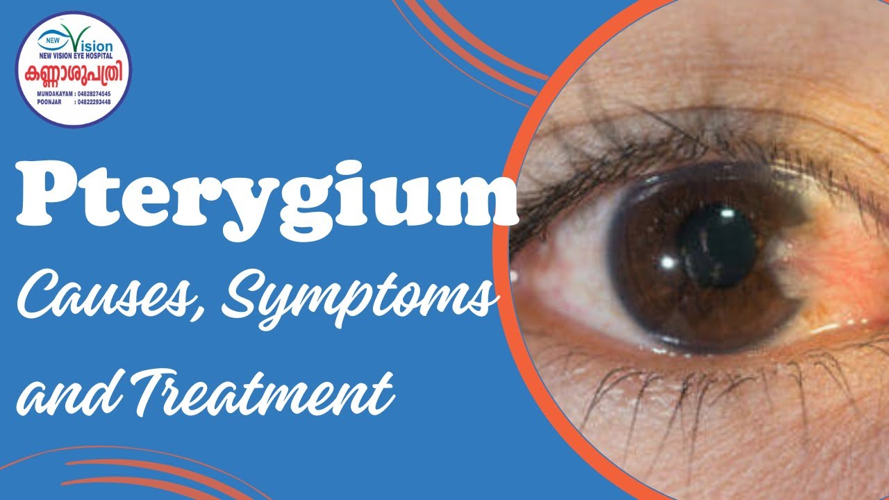 PTERYGIUM UNDERSTANDING PTERYGIUM CAUSES SYMPTOMS AND TREATMENT PTERYGIUM UNDERSTANDING PTERYGIUM CAUSES SYMPTOMS AND TREATMENT