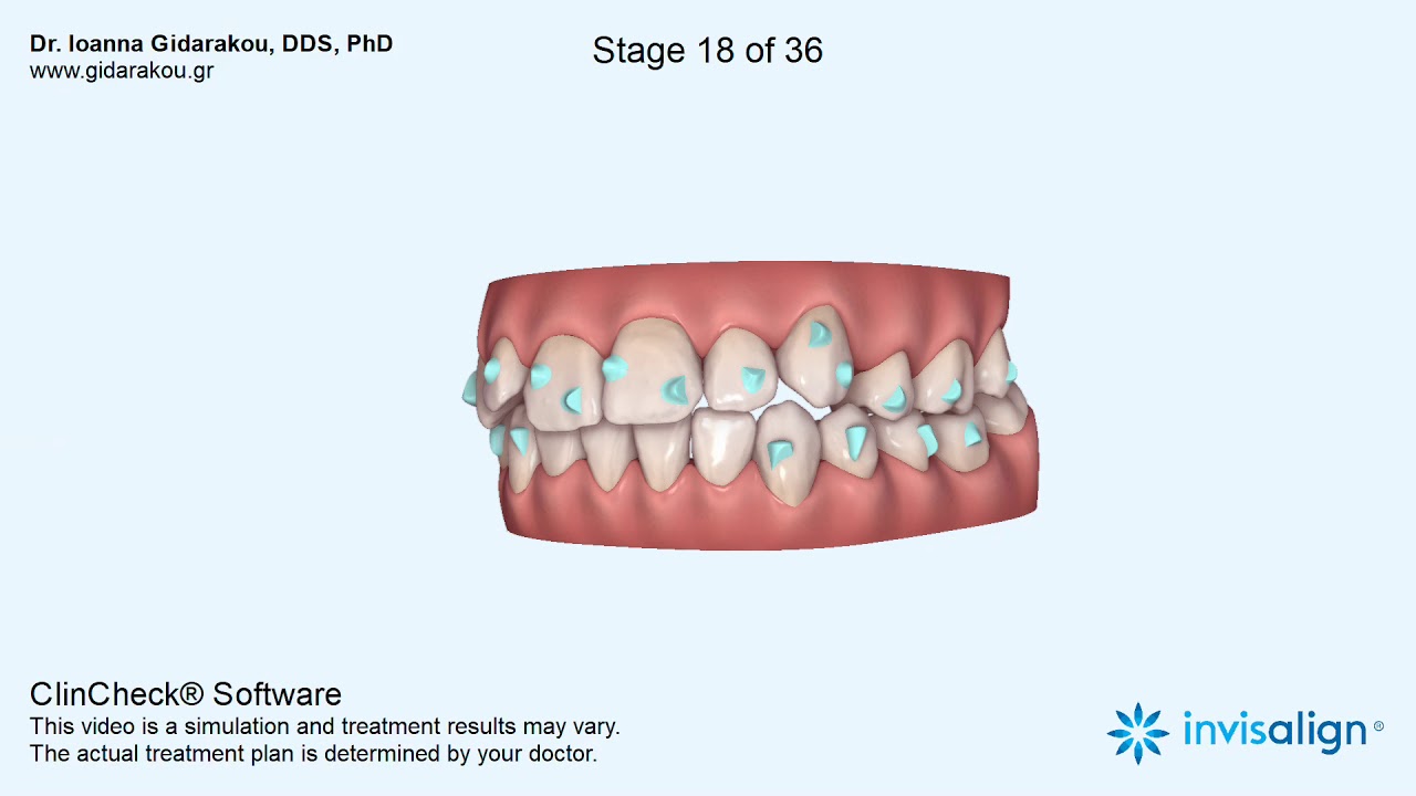 Extraction Invisalign case - YouTube