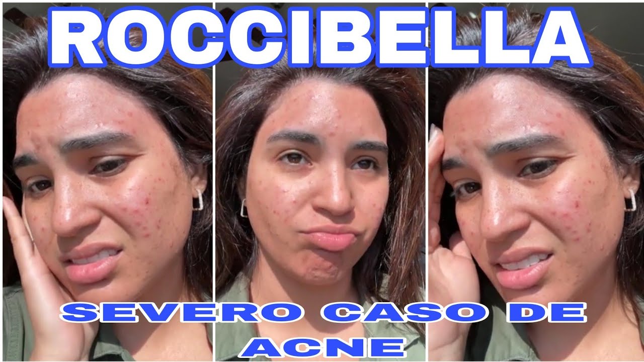 ROCCIBELLA PREOCUPADA POR EL SEVERO CASO DE ACNE QUE PADECE - YouTube