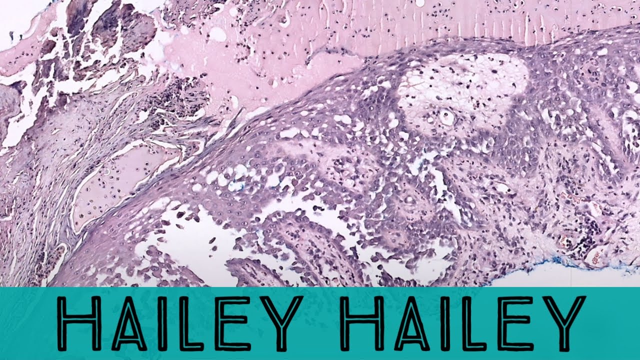 Hailey-Hailey Disease ("benign familial pemphigus") rash with blisters ...