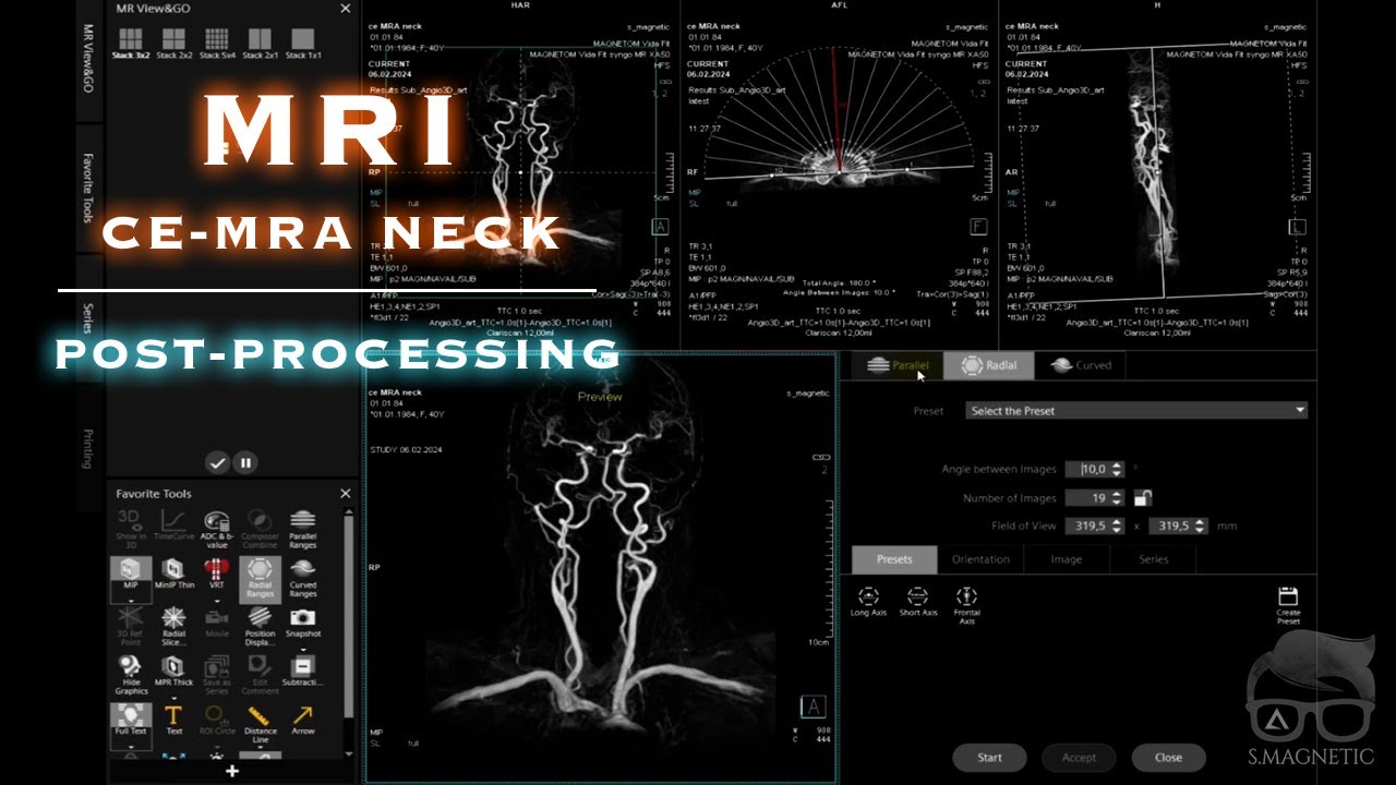 MRI – CE-MRA NECK & POST-PROCESSING - YouTube
