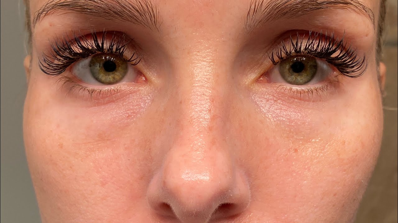 RETIN A WEEK 7 UPDATE // TRETINOIN - YouTube