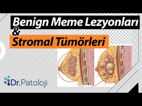 Benign Meme Lezyonları ve Stromal Tümörleri