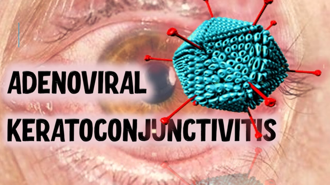 VIRAL CONJUNCTIVITIS | Ultimate Guide to Recognising Clinical Presentations - YouTube