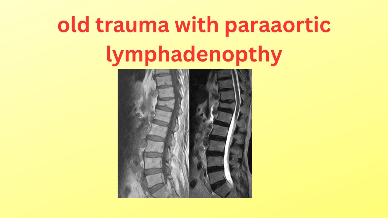 Old compression fracture with paraaortic lymphadenopathy - YouTube