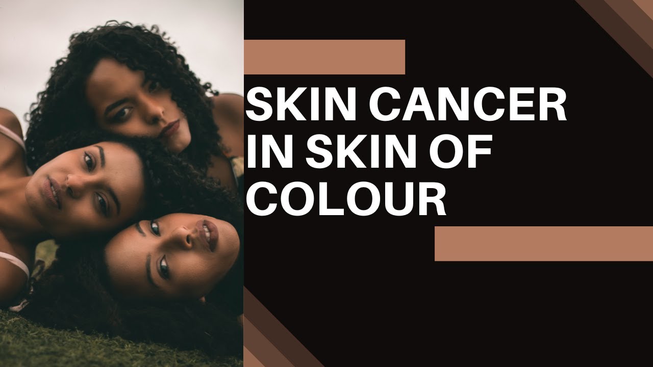 Skin cancer in skin of colour - YouTube