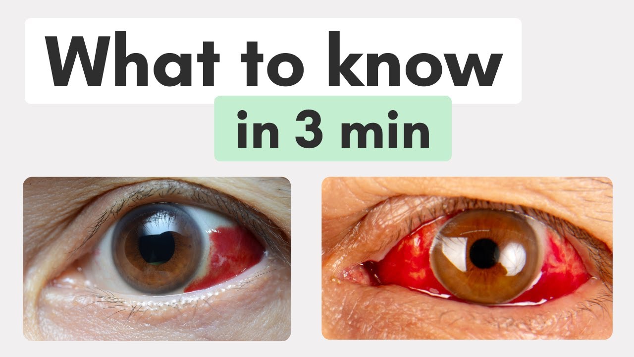 🩸Subconjunctival Hemorrhage: What Every Non-Eye Doctor Must Know in 3 ...