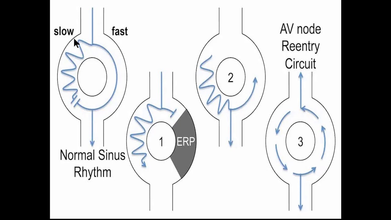 ECG, part 2, SVT, Atrioventricular Nodal Re-entry Tachycardia (AVNRT ...