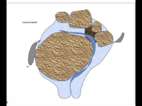 Laparoscopic Myomectomy for multiple myomas - YouTube