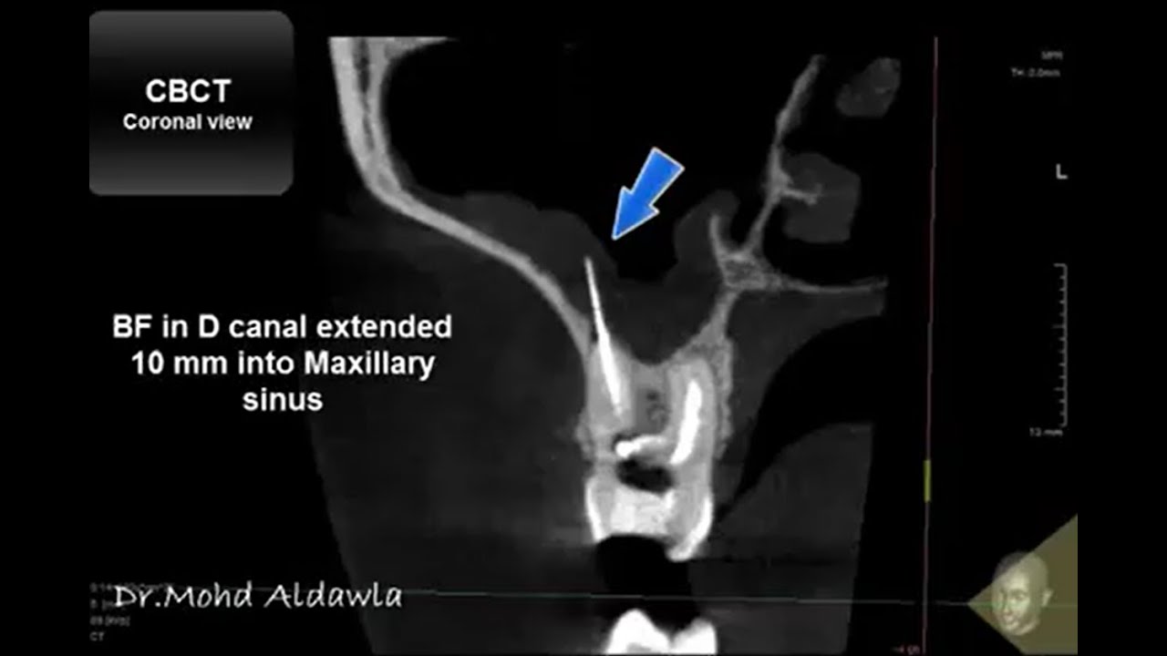 Separated file removal. Endodontics - YouTube