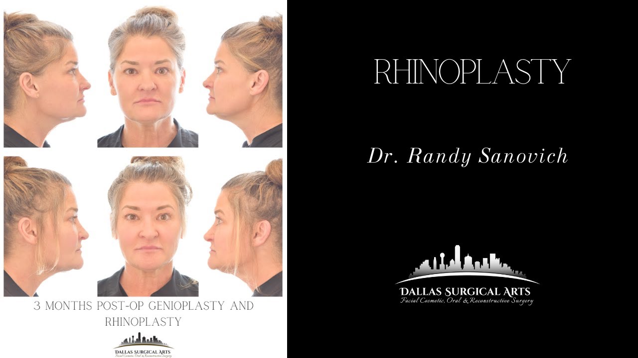 A Look Inside The OR: Rhinoplasty by Dr. Randy Sanovich - YouTube