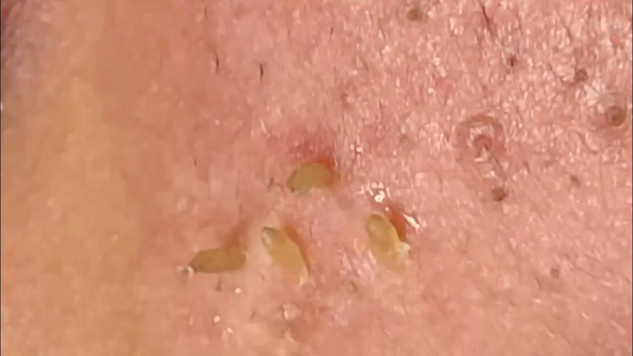 🔥 Pimple Popping 2020 Video| Blackheads extraction| Blackheads removal ...