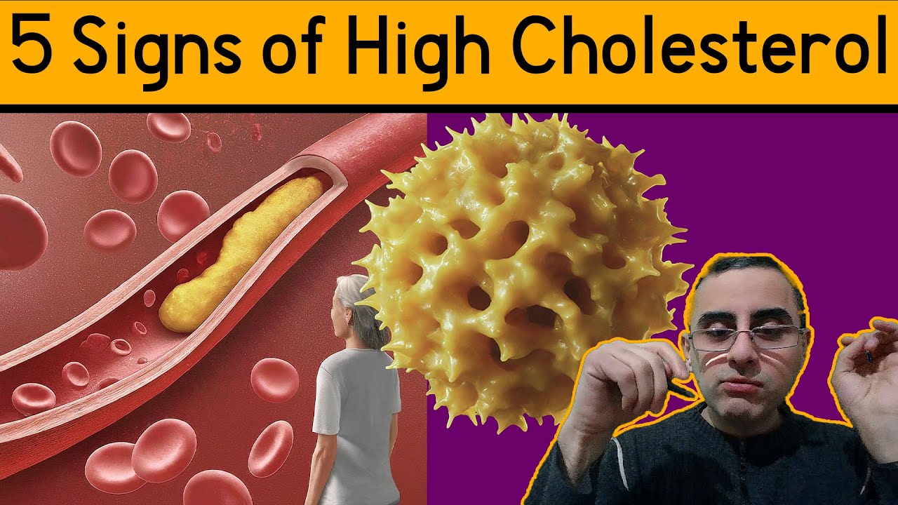 5 Signs of High Cholesterol - YouTube