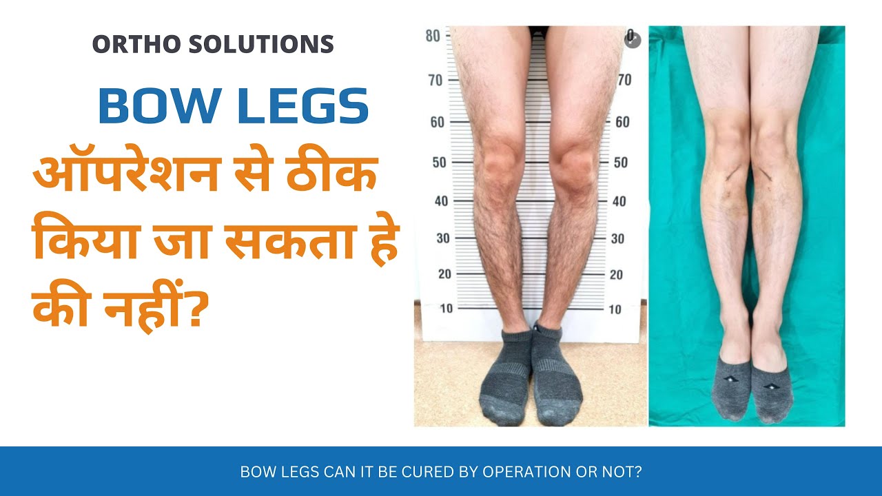 Bow Legs: How to Fix Bow Legs | ऑपरेशन से ठीक किया जा सकता हे की नहीं ...