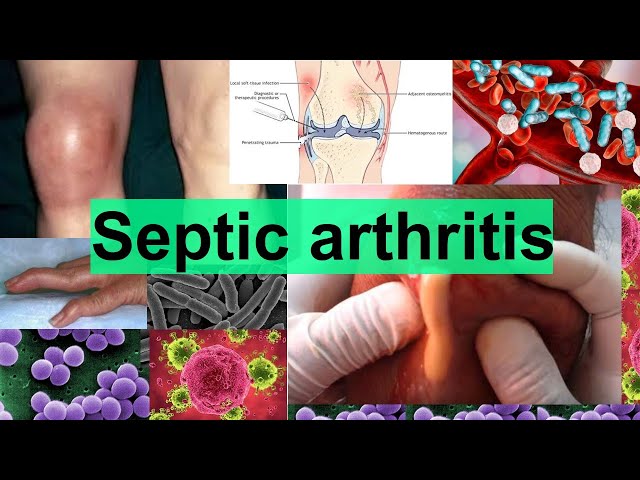 Septic Arthritis Hand