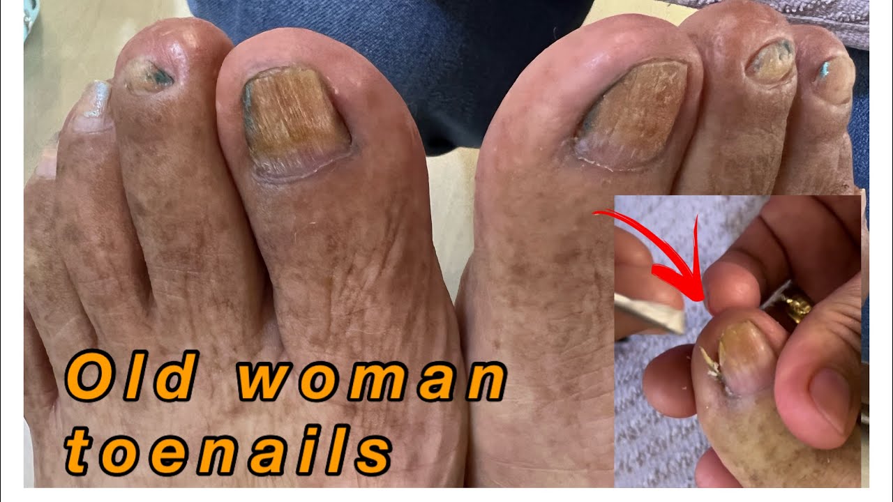 Vlogs #106 OLD WOMAN TOENAILS DRYSKIN REMOVAL | new upload - YouTube