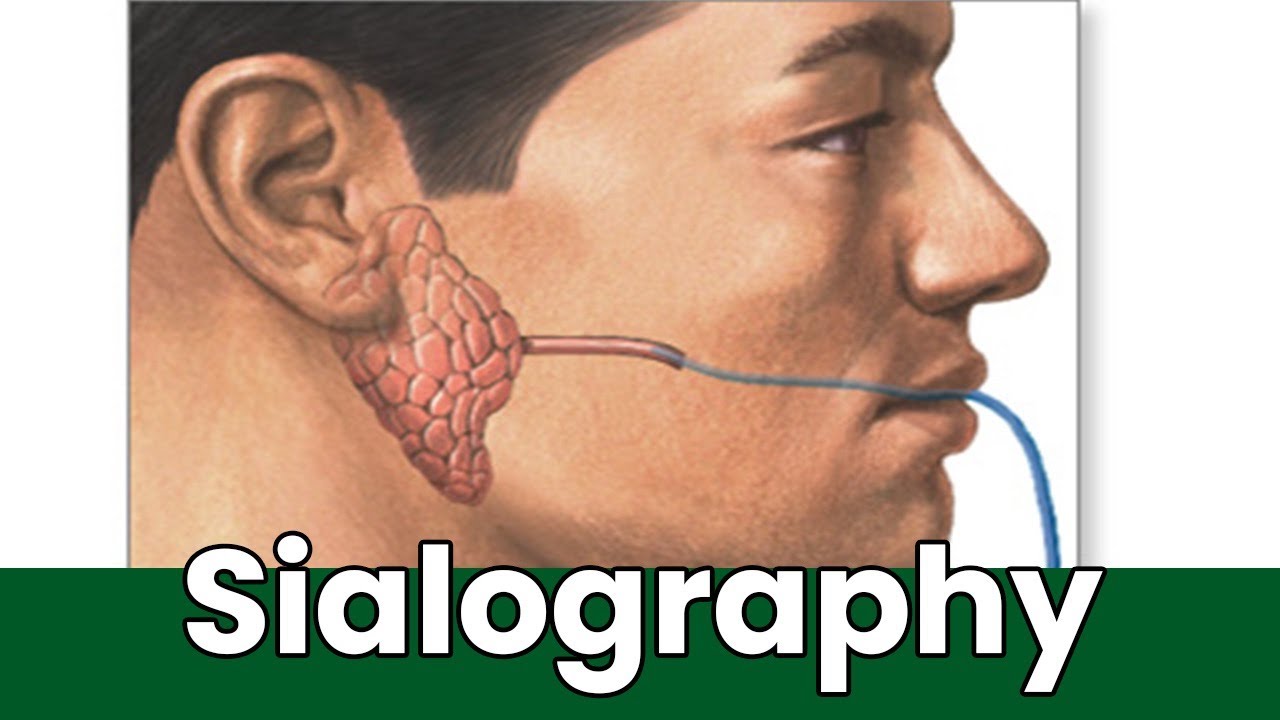 What Is Sialography: Overview, Uses, And The Procedure? How Is ...