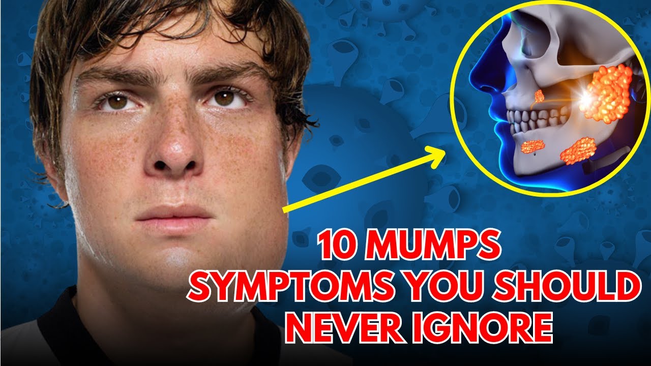 Mumps Infection: Top 10 Mumps Symptoms You Should Never Ignore - YouTube