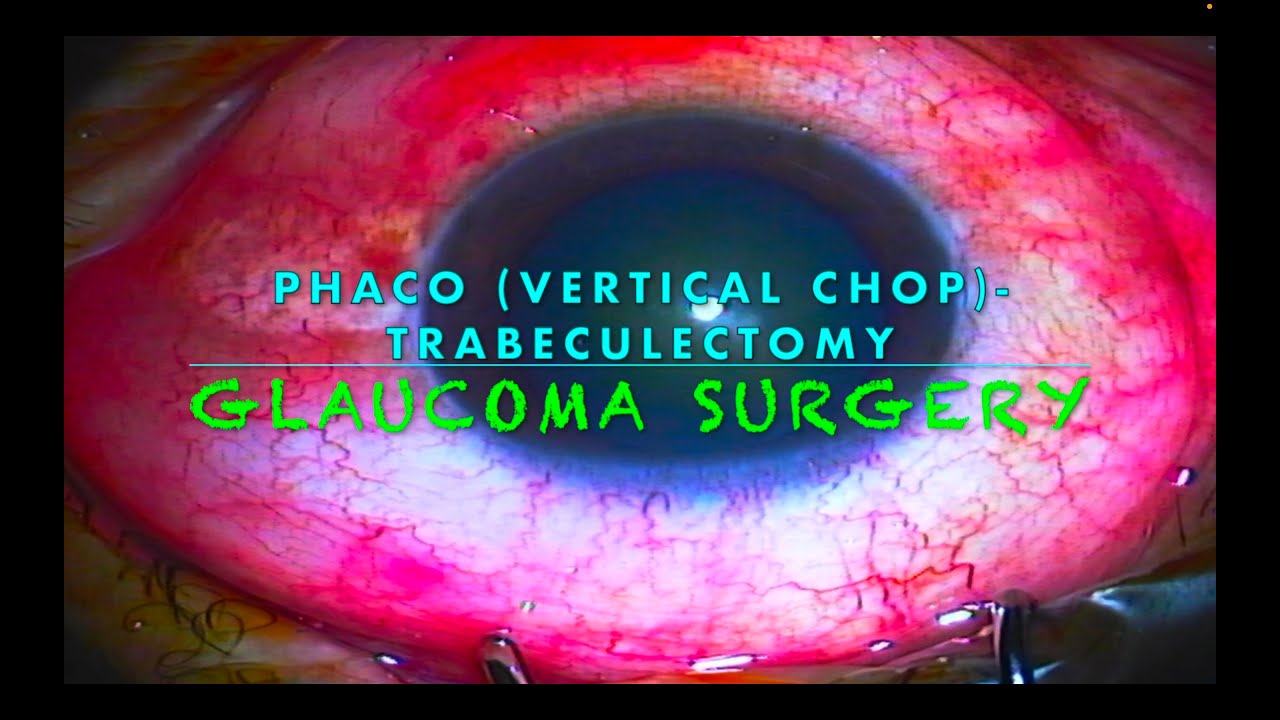MIIQ 22: Glaucoma Surgery || Phaco (Vertical Chop)-Trabeculectomy || DR ...