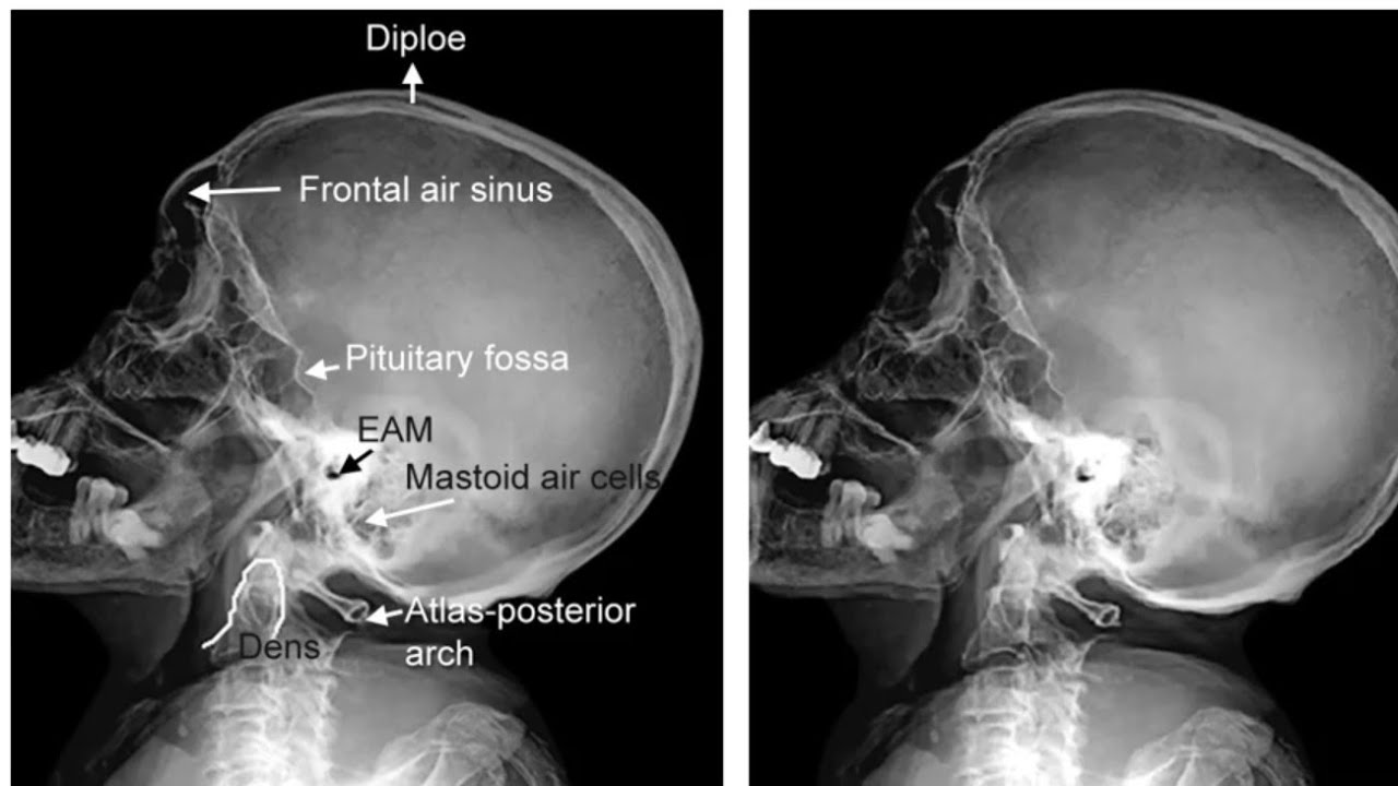 RADIOLOGY and SURFACE Marking of Head n Neck / ANATOMY - YouTube