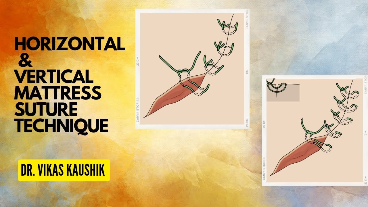 Horizontal and Vertical Mattress Suture Technique. Demonstration on ...