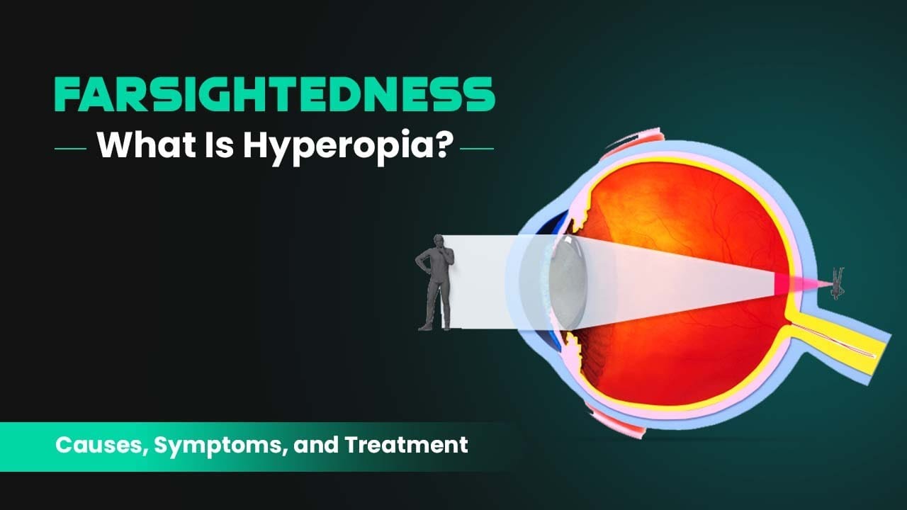 Farsightedness: What Is Hyperopia? Causes, Symptoms, and Treatment 3D ...
