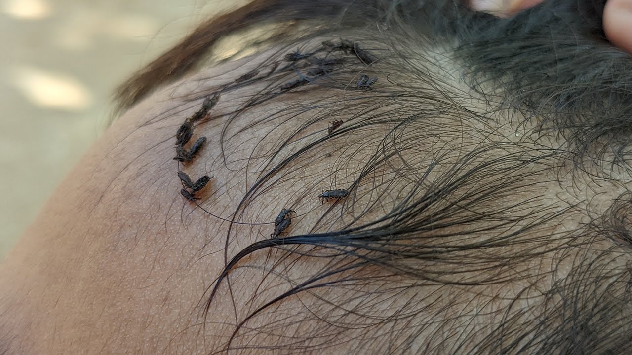 Picking a hundred head lice from hair - Reduce a lot of head lice by ...
