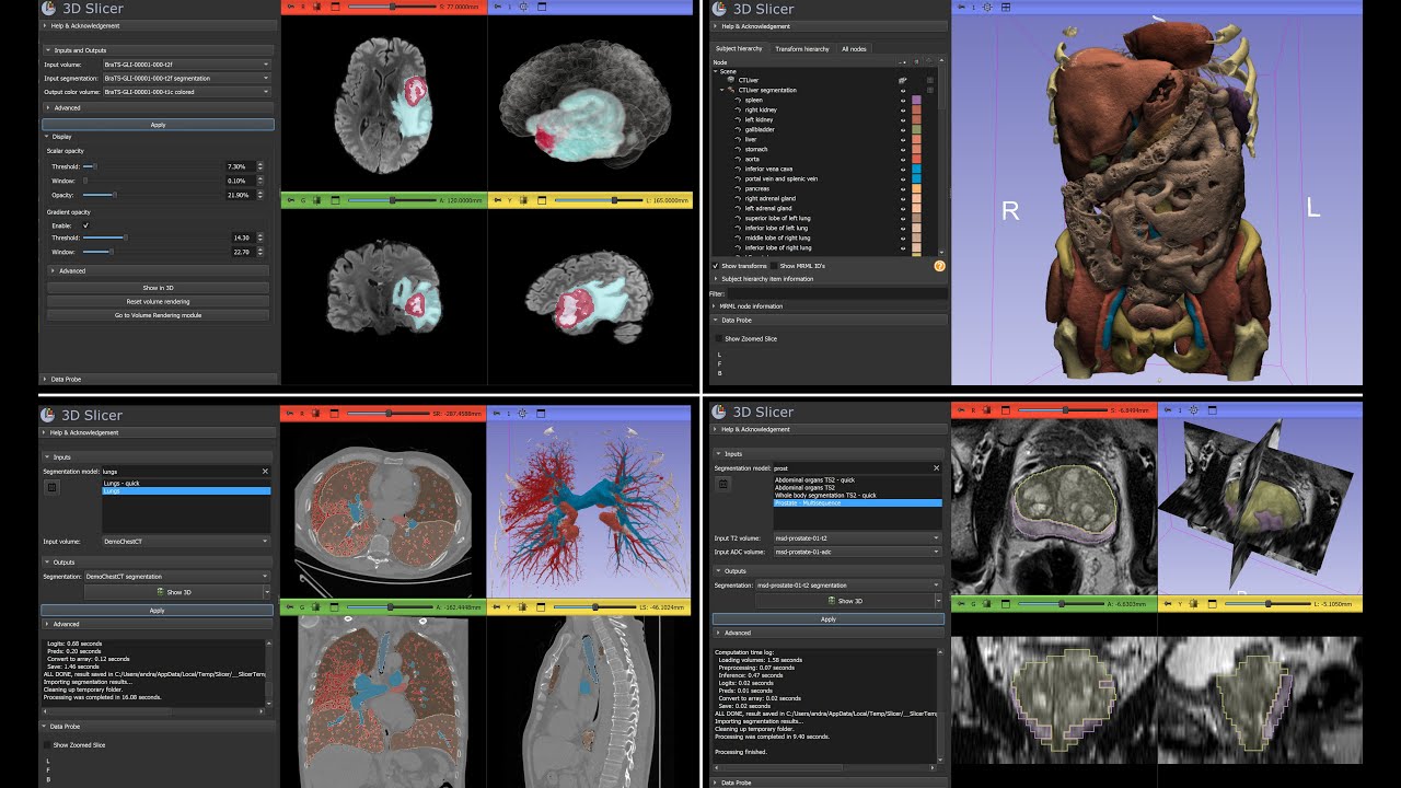 Automatic Multi Modality Ai Medical Image Segmentation In 3d Slicer Using Monaiauto3dseg