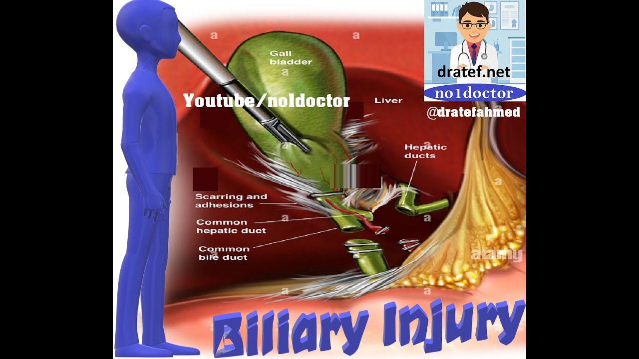 Biliary Injury /Surgical Problems/ Management of Bile Duct injury ...