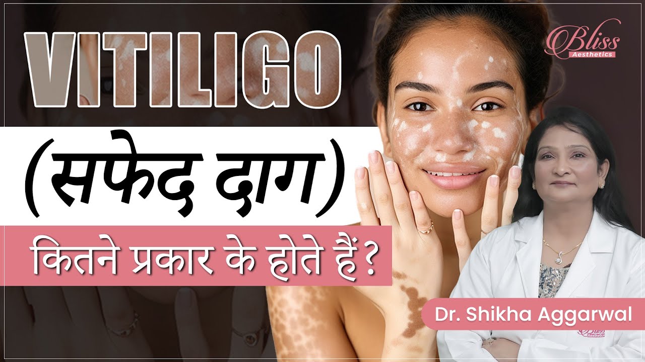 Vitiligo Skin Disease | Vitiligo Treatment | Types of Vitiligo | Skin ...