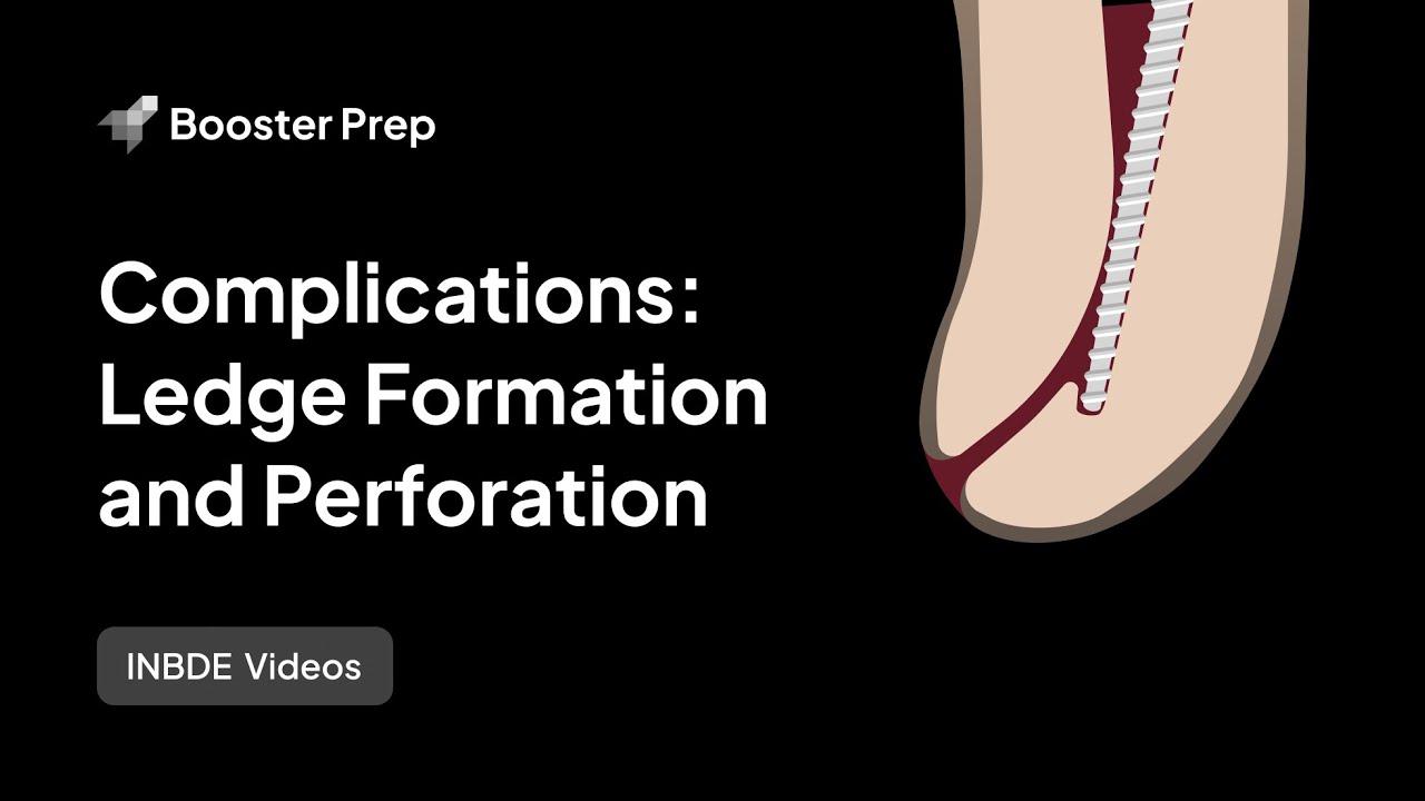Complications - Ledge Formation and Perforation [2024 INBDE, NDEB, ADAT ...
