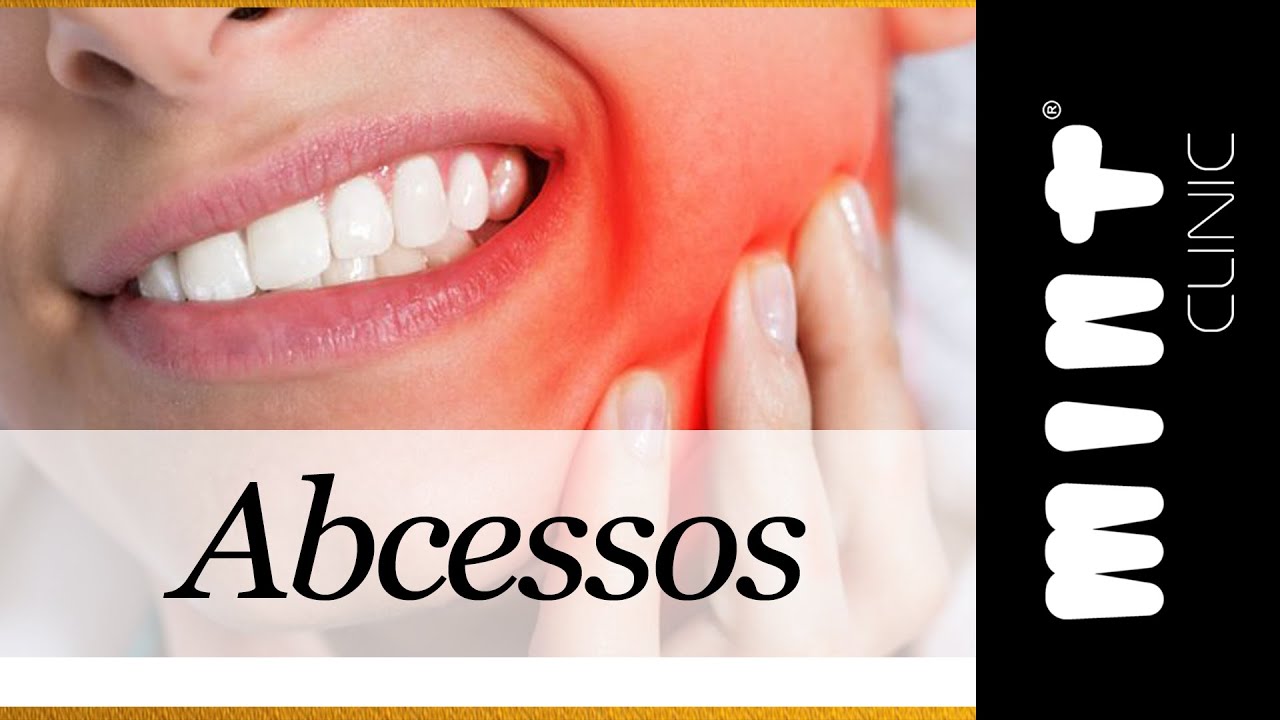 Abcessos Dentários - Clínica Mint - YouTube