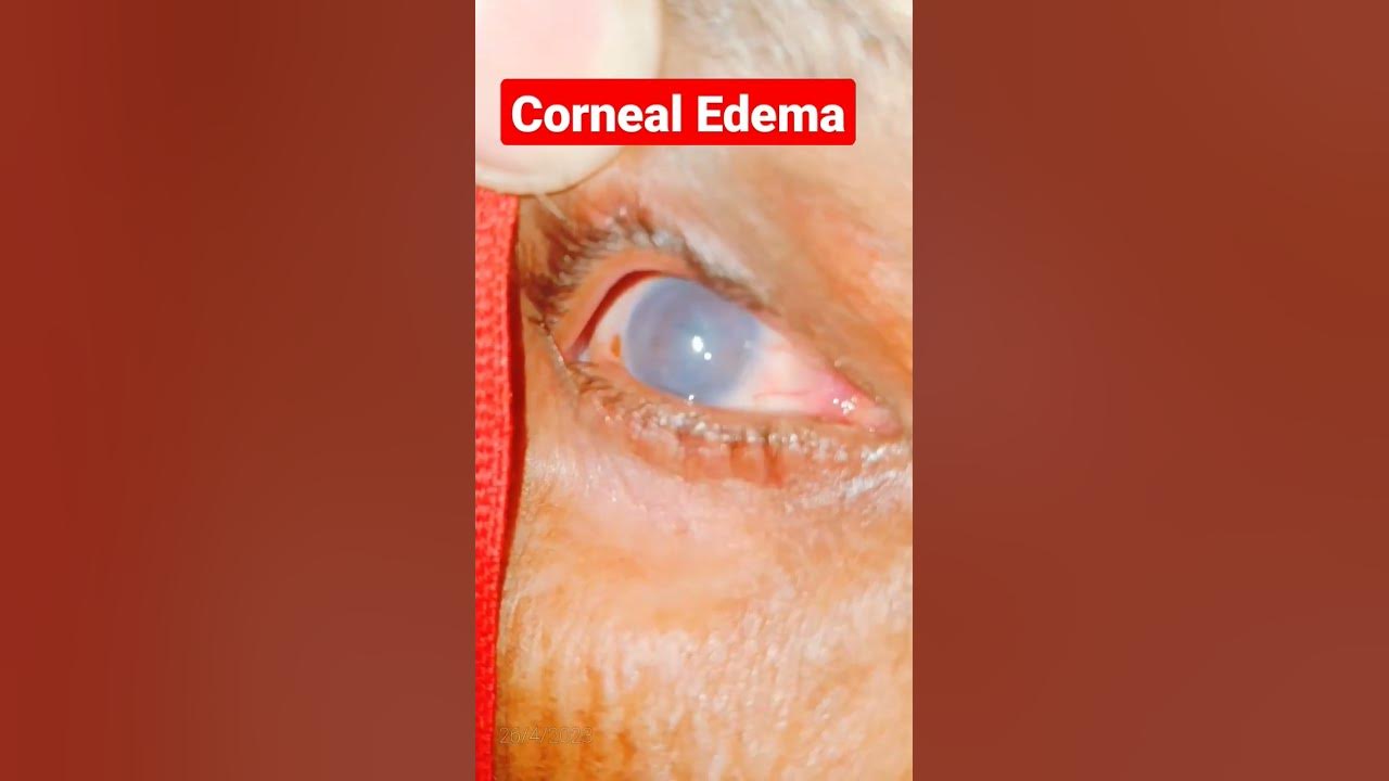 Corneal Edema After Cataract Surgery Post Opt Cornea Cataract Edema