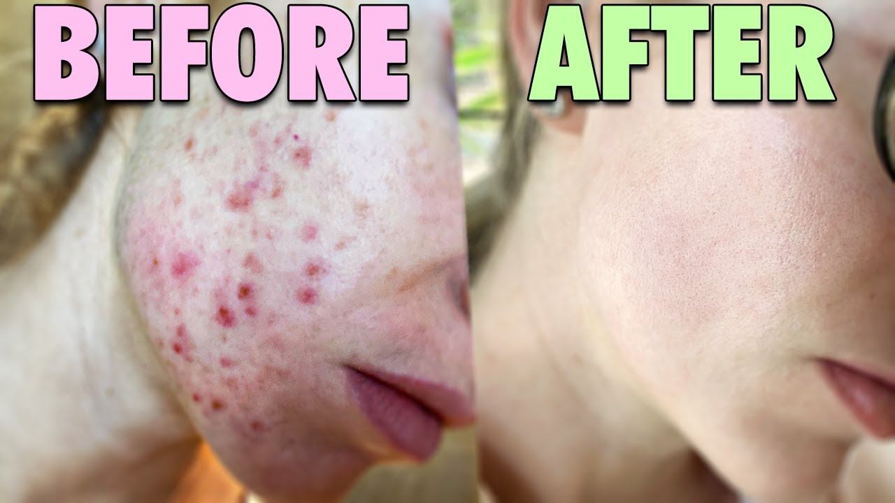 My Evidence Based Acne Cure (when nothing else worked) - YouTube