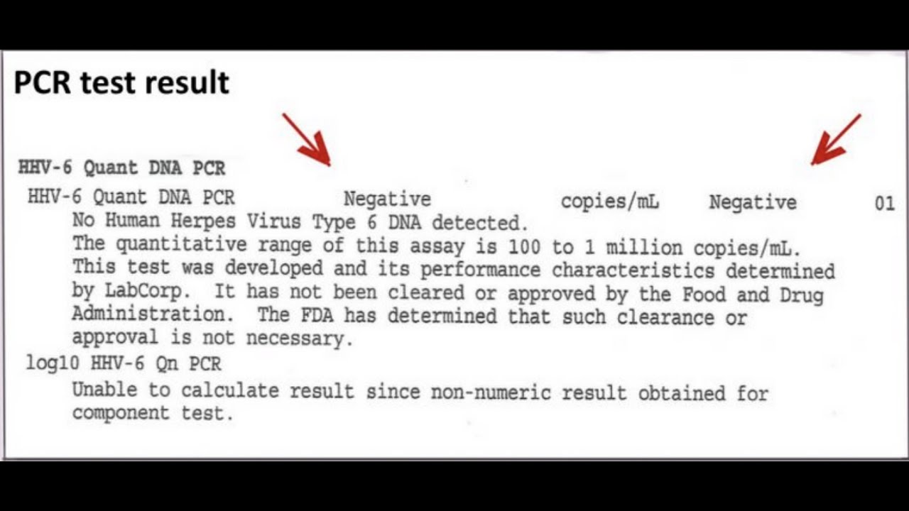 Human Herpesvirus 6 PCR Test - NEGATIVE Following Scalar Light Sessions ...