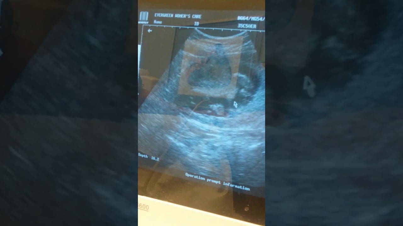 Twins at 12 Weeks 💕 - YouTube