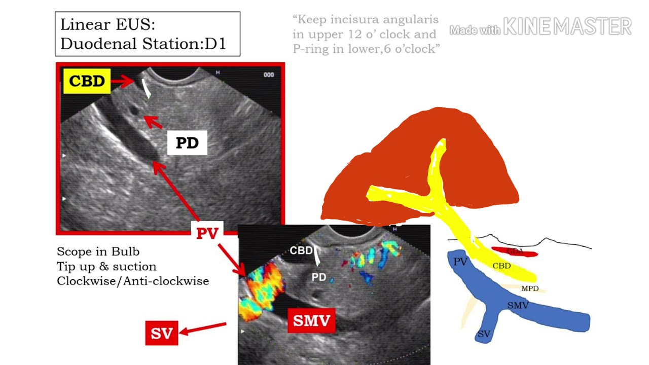 EUS : Linear Anatomy III (Duodenal Bulb) - TWFC - YouTube