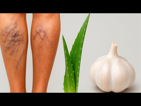 KRAMPFADER BEHANDELN! Hausmittel gegen Schmerzen und MÜDE Beine 💪🌿