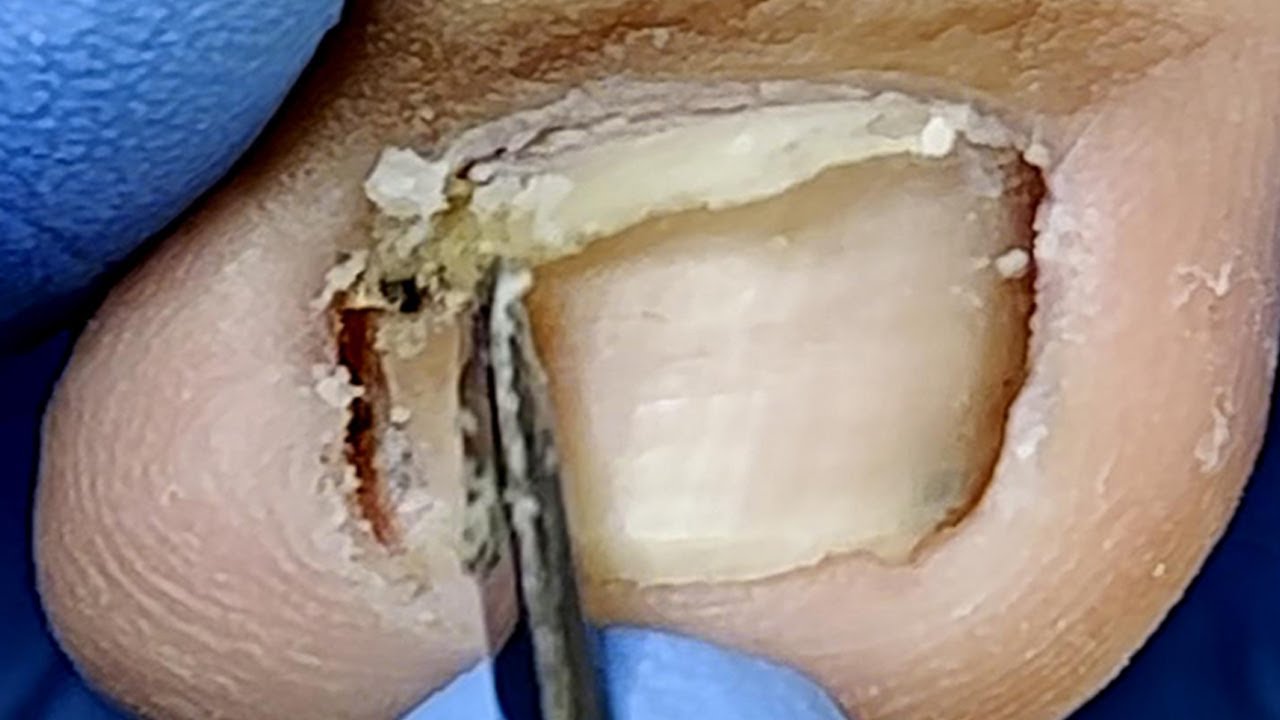 Easily trim toenails in 1 minute! foot health【Xue Yidao Pedicure】 - YouTube